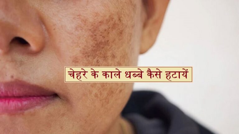 चेहरे पर काले धब्बे / Melasma के लिए आयुर्वेदिक उपचार